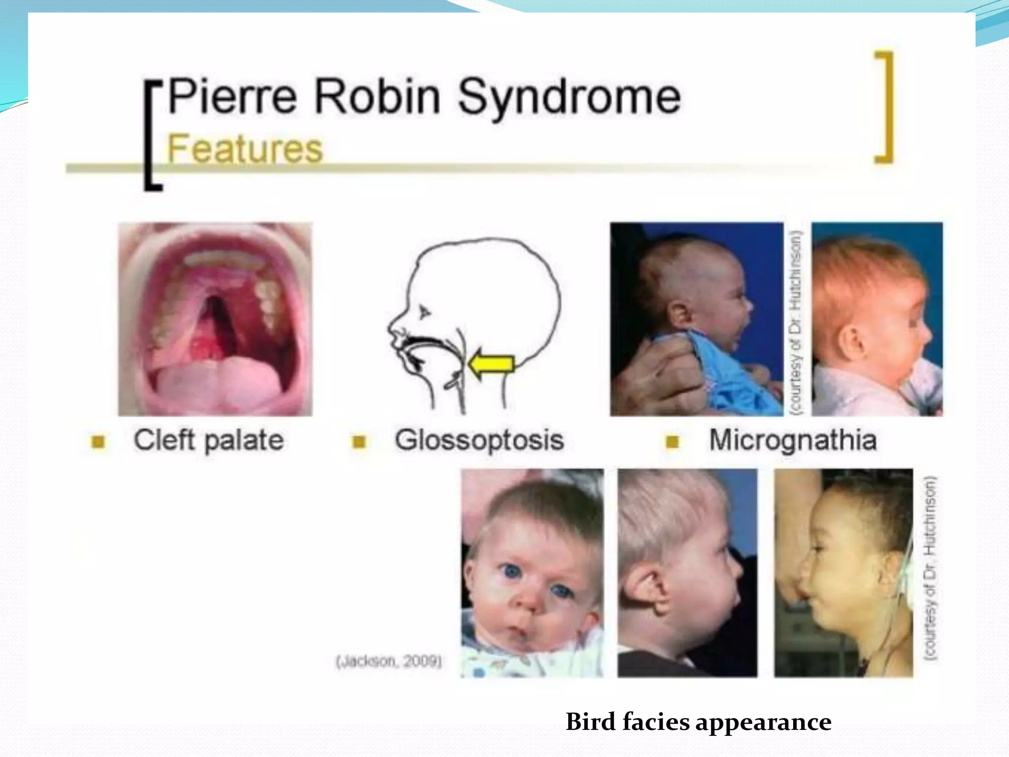 Developmental disturbances of the jaws | PPTX
