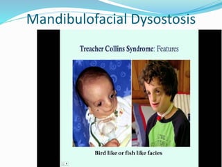 Developmental disturbances of the jaws | PPTX