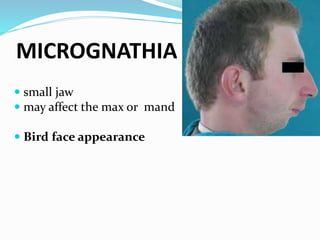 Developmental disturbances of the jaws | PPTX