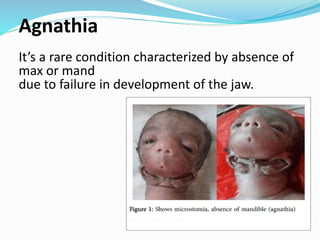 Developmental disturbances of the jaws | PPT