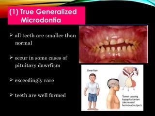 True Generalized Microdontia