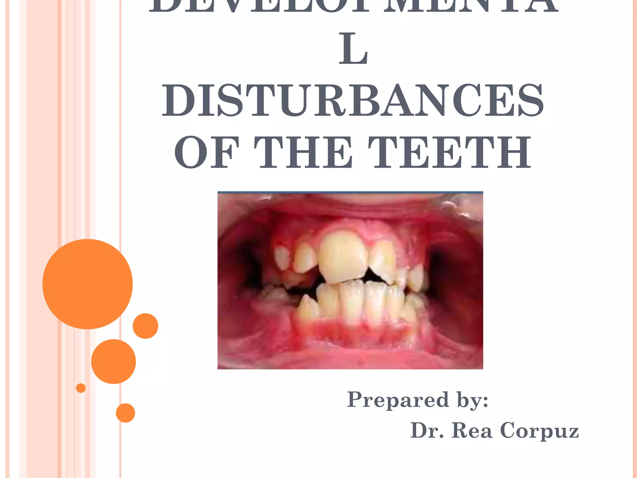 Developmental disturbances of the Teeth | PPT