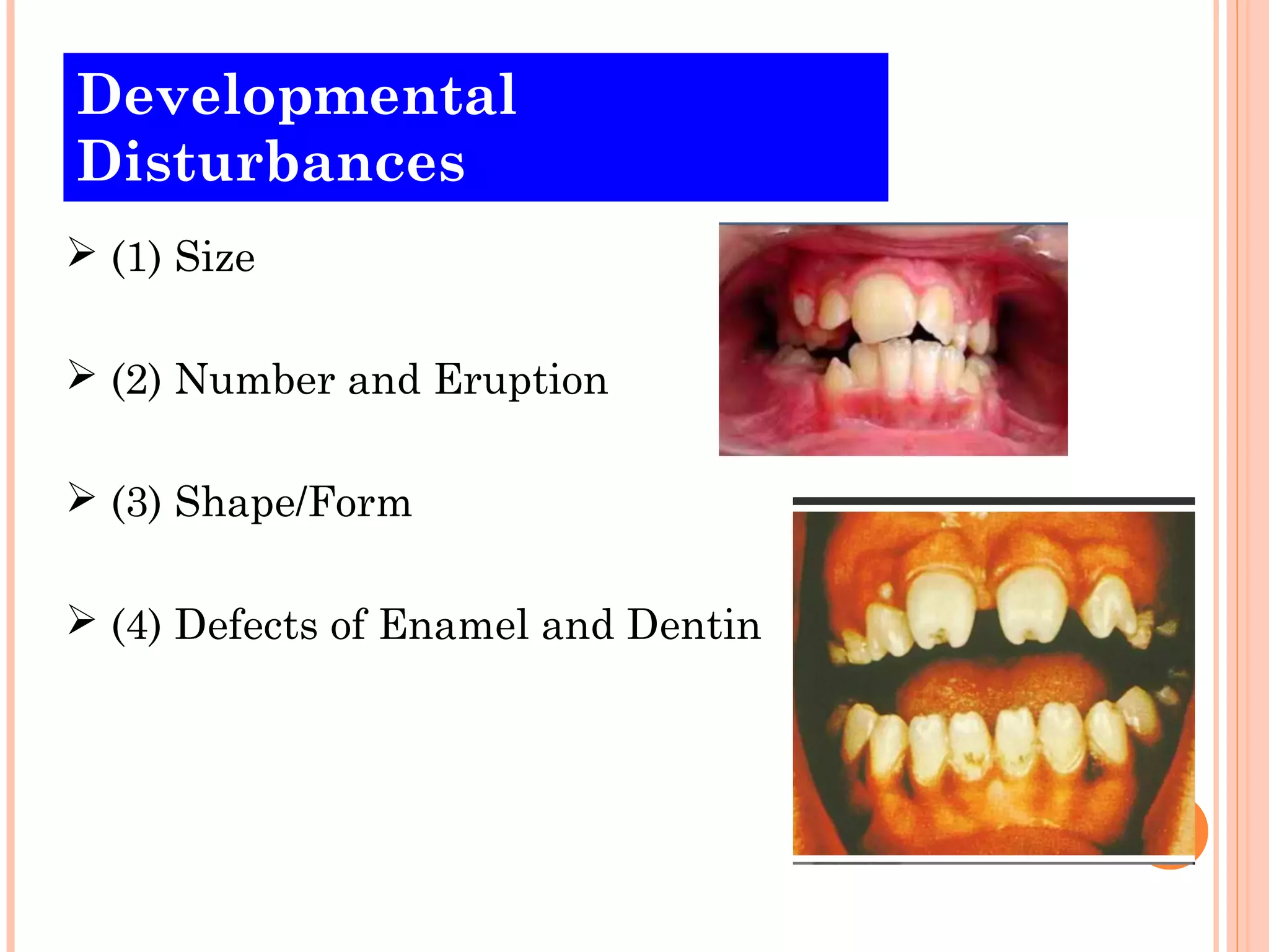 Developmental disturbances of the Teeth | PPT