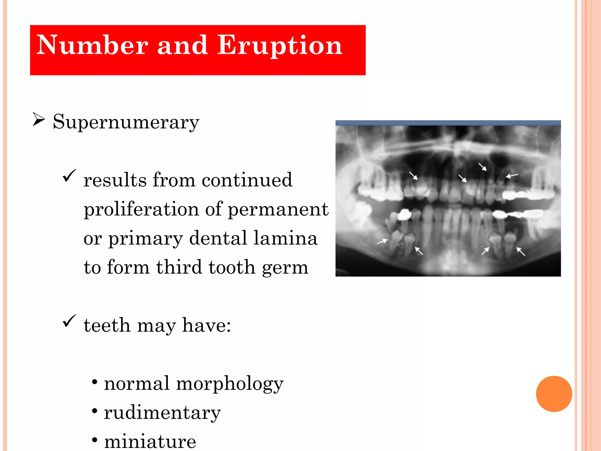 Developmental disturbances of the Teeth | PPT