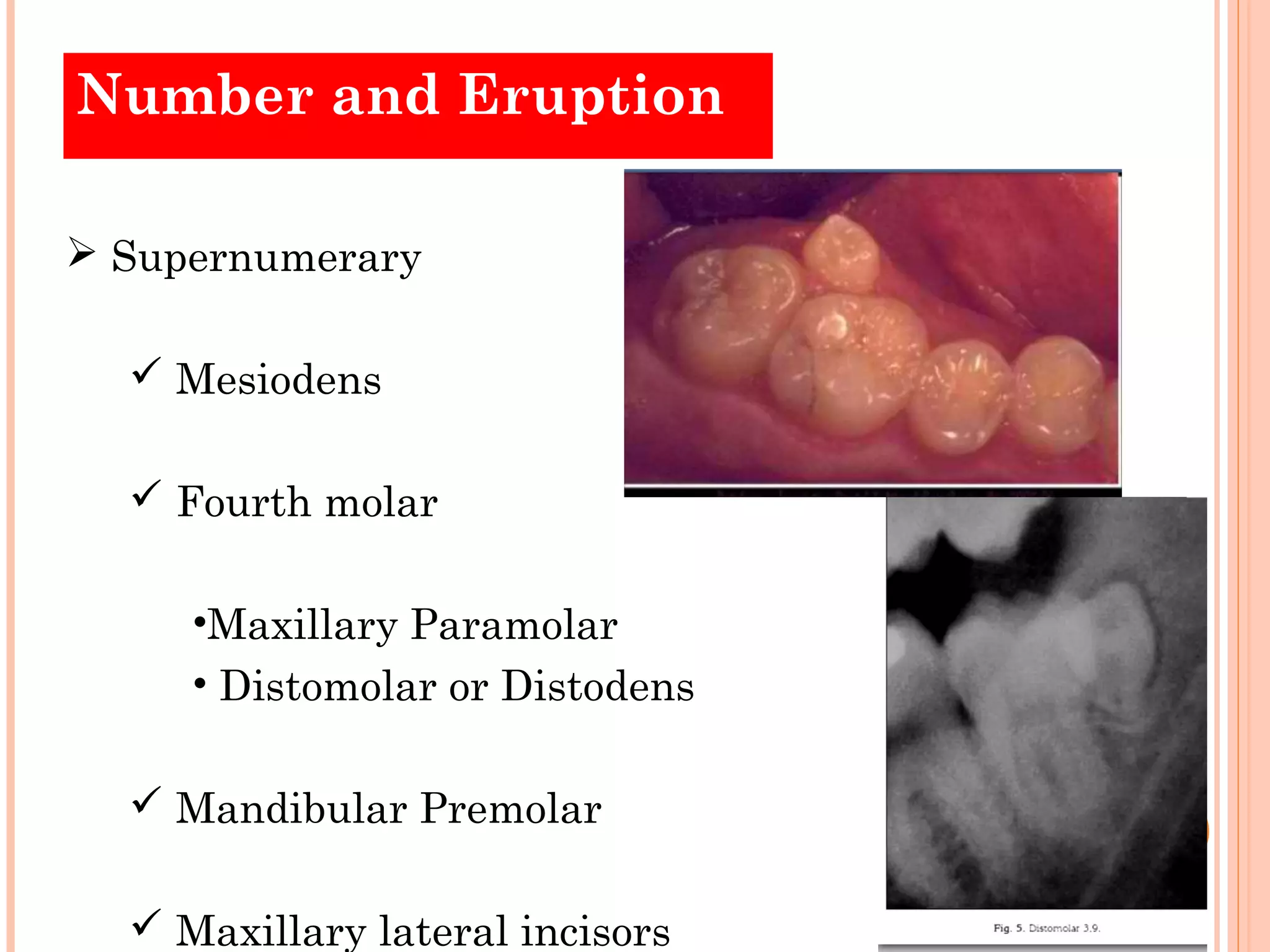 Developmental disturbances of the Teeth | PPT