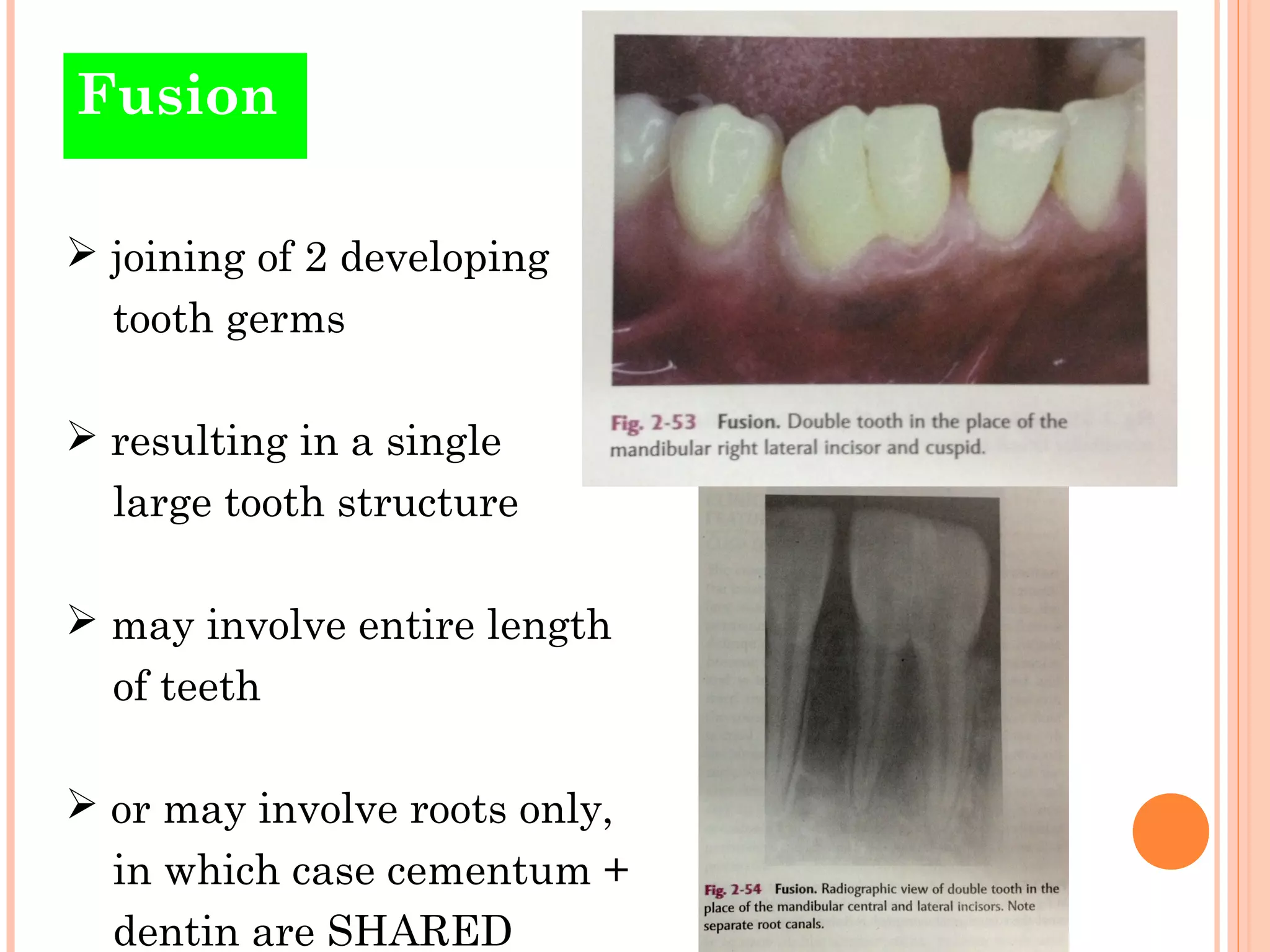 Developmental disturbances of the Teeth | PPT | Dental Health ...
