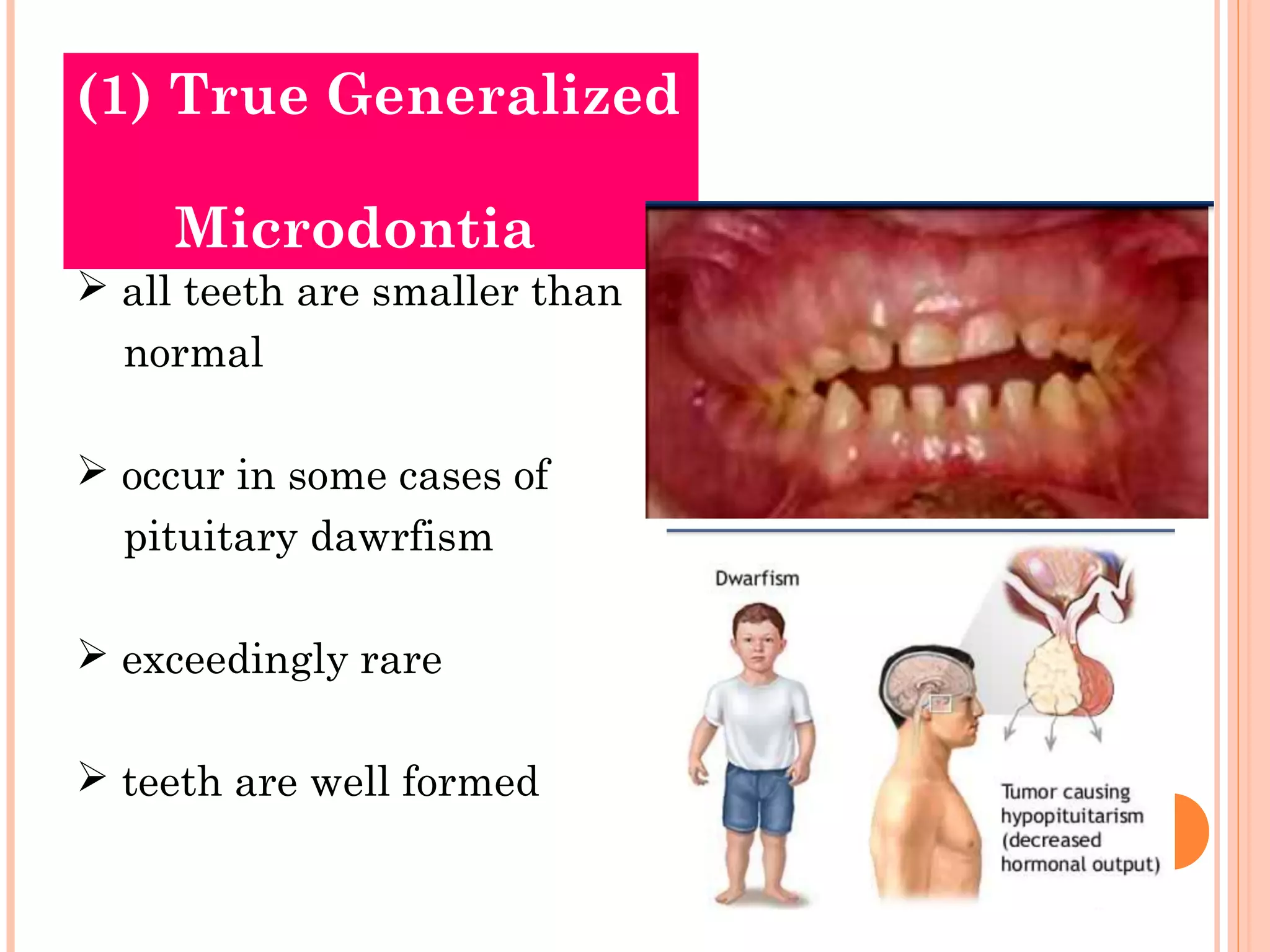 Developmental disturbances of the Teeth | PPT
