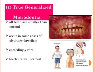 True Generalized Microdontia