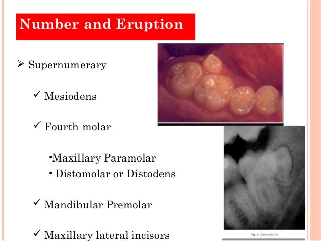 Developmental disturbances of the Teeth