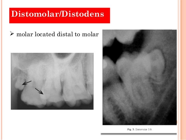 Developmental disturbances of the Teeth