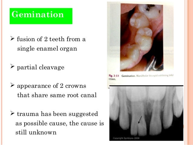 Developmental disturbances of the Teeth