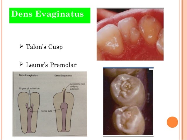 Developmental disturbances of the Teeth