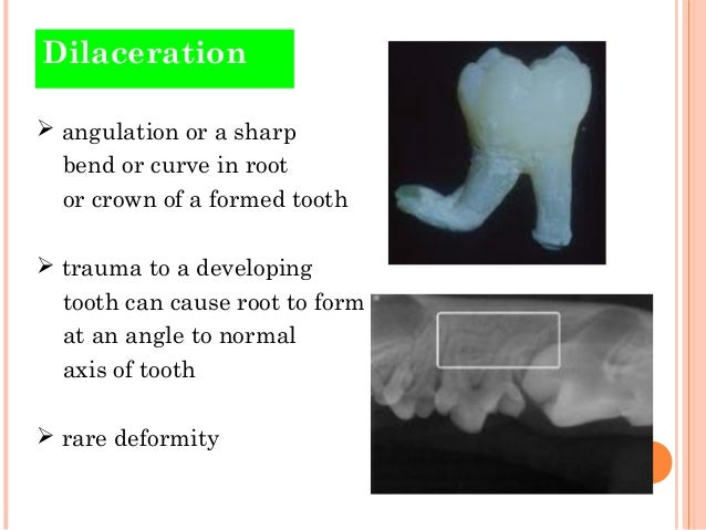 Developmental disturbances of the Teeth