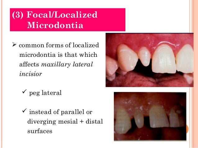 Developmental disturbances of the Teeth