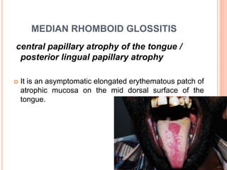 Developmental disturbances of tongue | PPTX