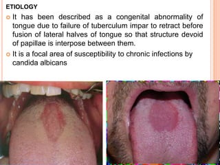 Developmental disturbances of tongue | PPTX
