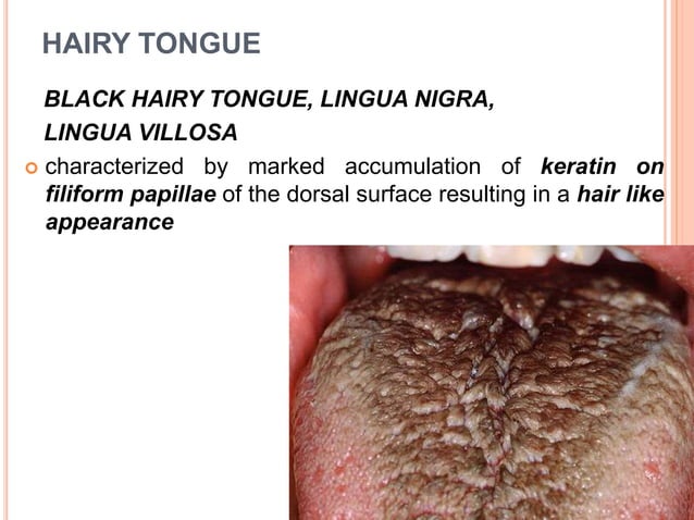 Developmental disturbances of tongue | PPTX