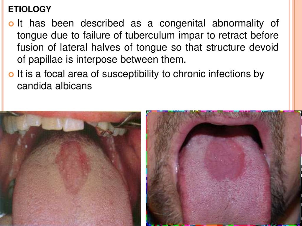 Developmental disturbances of tongue