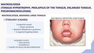 developmental disturbances of tongue.pptx