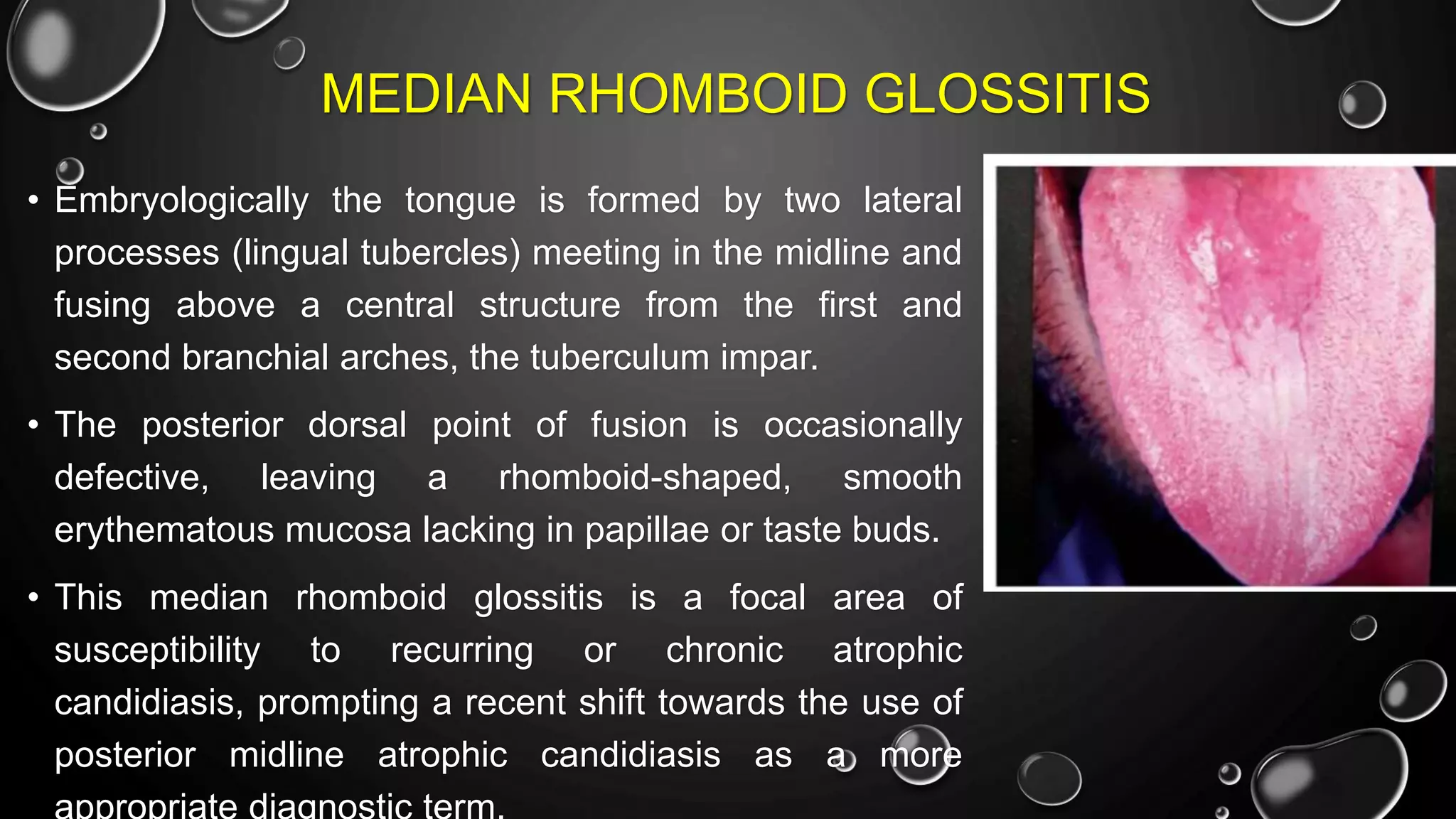 DEVELOPMENTAL DISTURBANCES OF TONGUE | PPTX