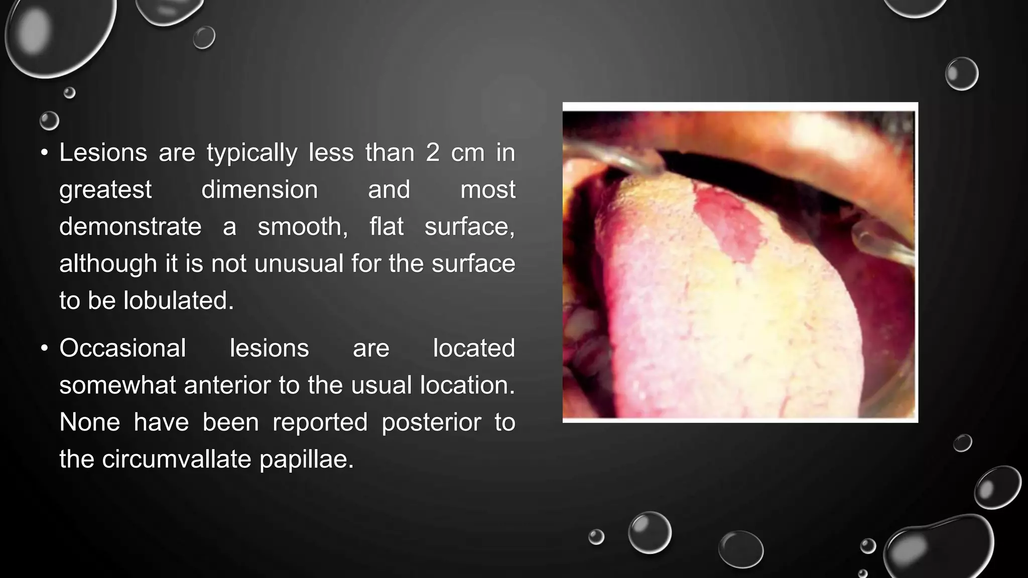 DEVELOPMENTAL DISTURBANCES OF TONGUE | PPTX
