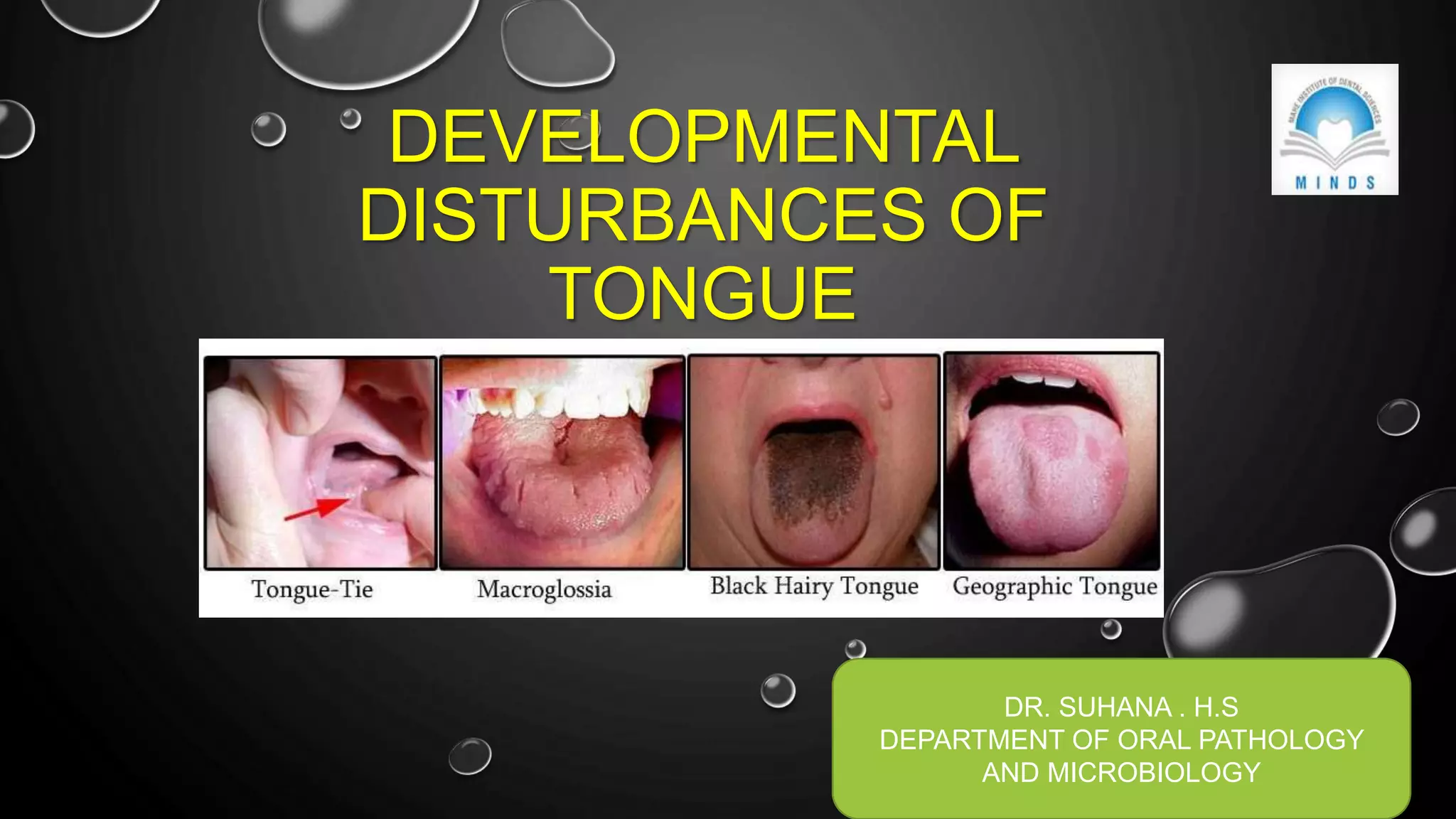 DEVELOPMENTAL DISTURBANCES OF TONGUE | PPTX