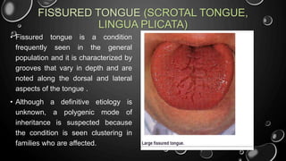Lingua Plicata Images _ Clinical evaluation of lingua plicata in adults ...