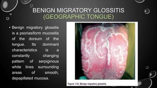 DEVELOPMENTAL DISTURBANCES OF TONGUE | PPTX
