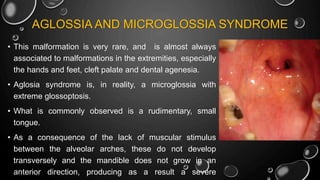DEVELOPMENTAL DISTURBANCES OF TONGUE | PPTX