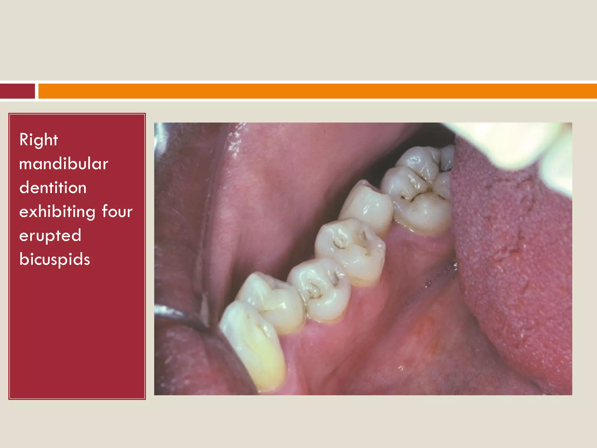 Developmental disturbances of tooth morphology | PDF