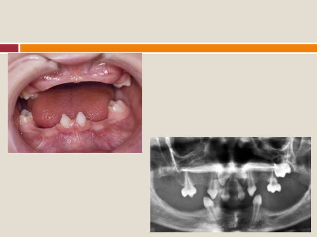 Developmental disturbances of tooth morphology | PPT