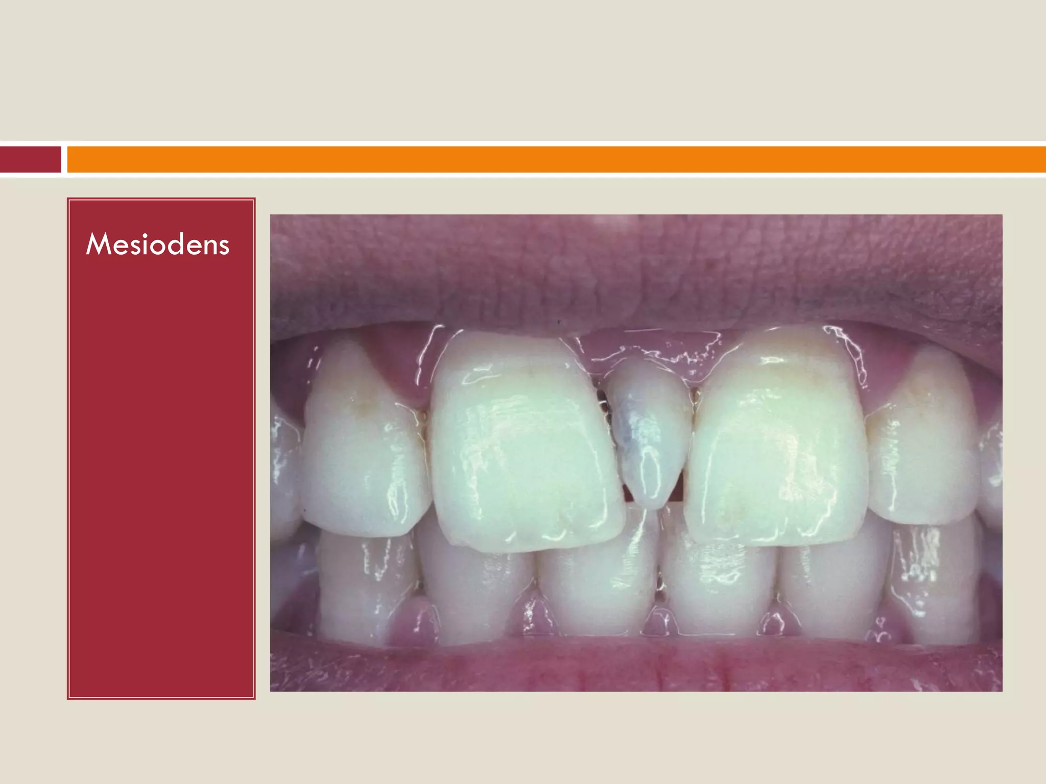 Developmental disturbances of tooth morpology | PPT