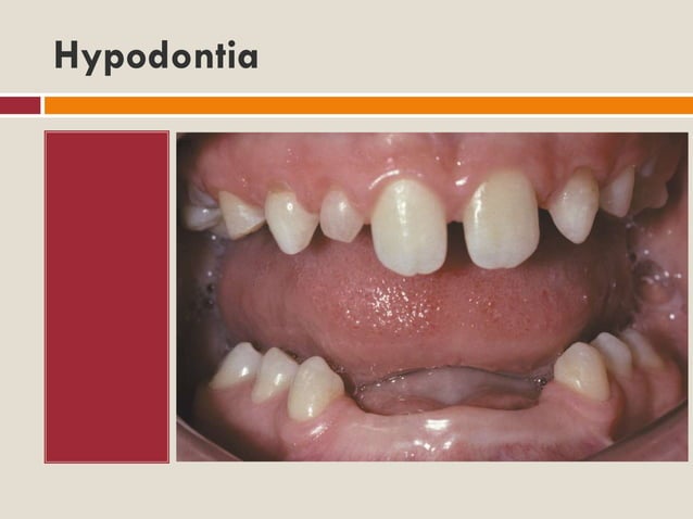 Developmental disturbances of tooth morpology | PPT