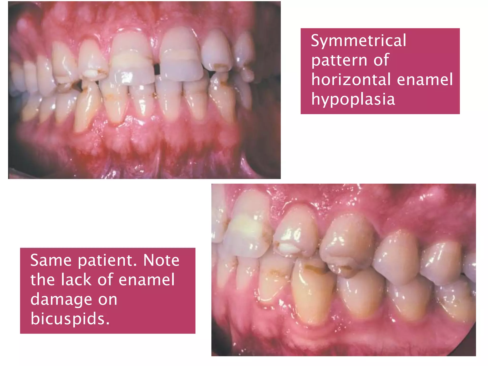 Developmental disturbances of tooth structure | PDF