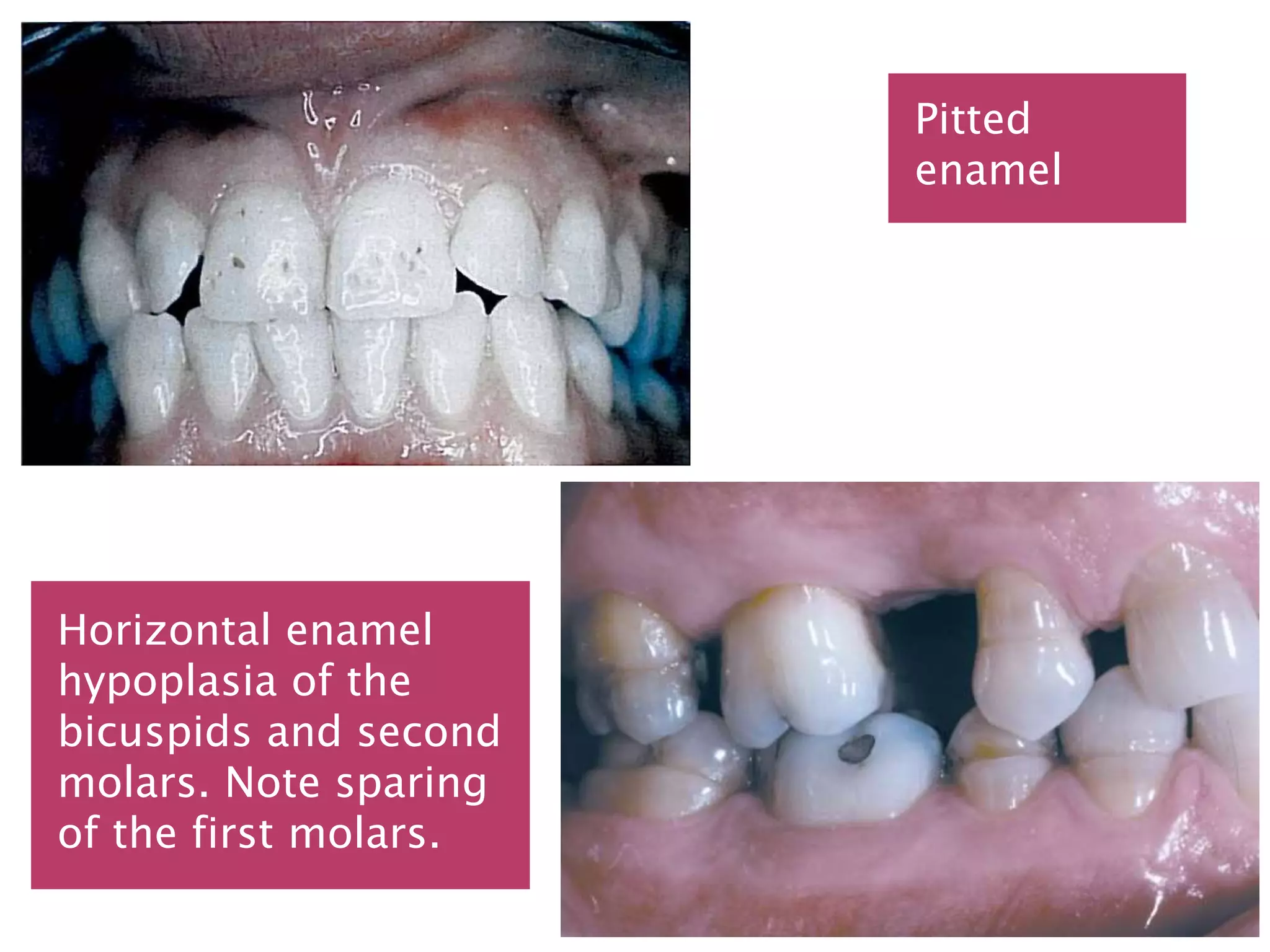Developmental disturbances of tooth structure | PDF