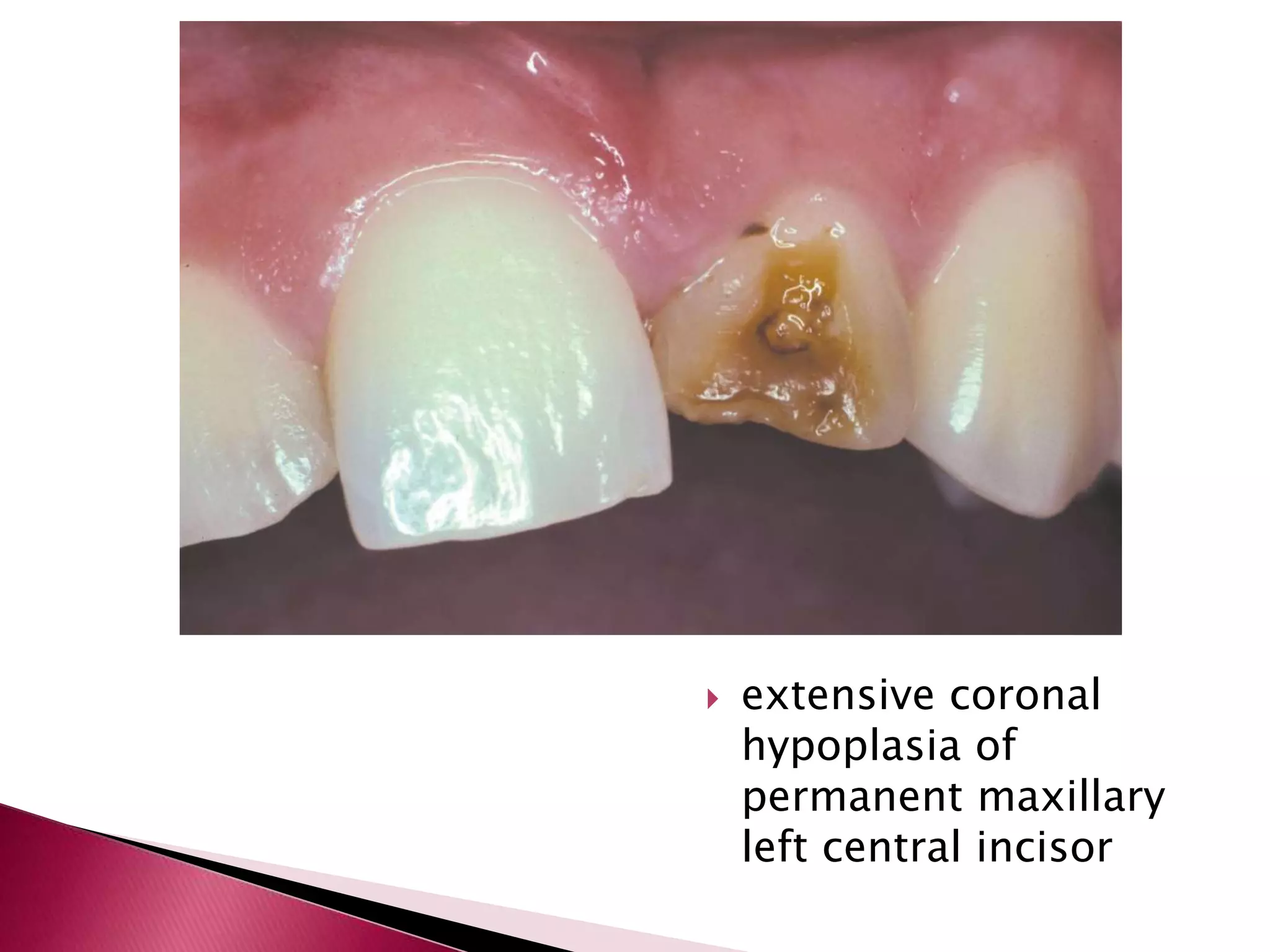 Developmental disturbances of tooth structure | PDF