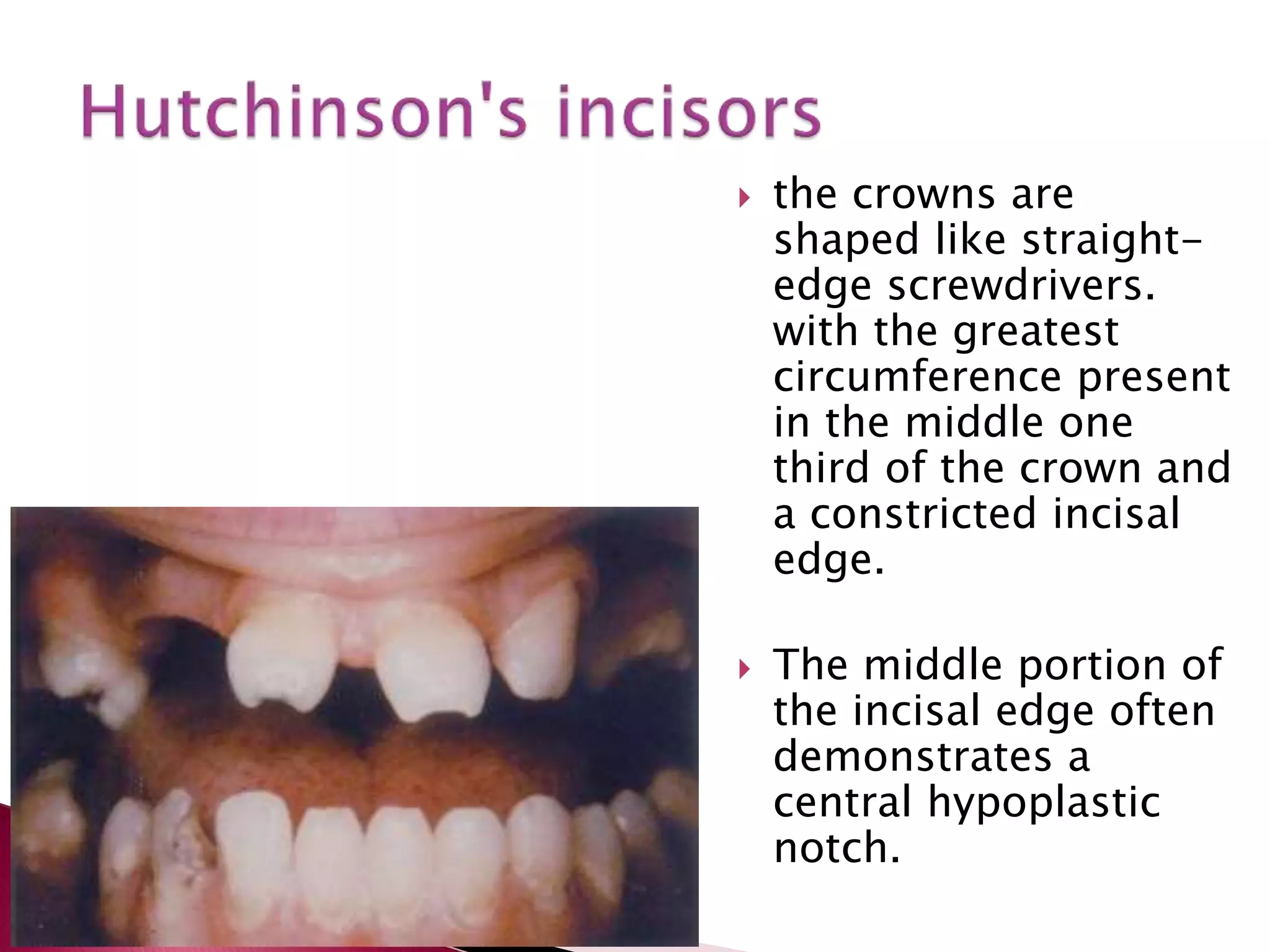 Developmental disturbances of tooth structure | PDF