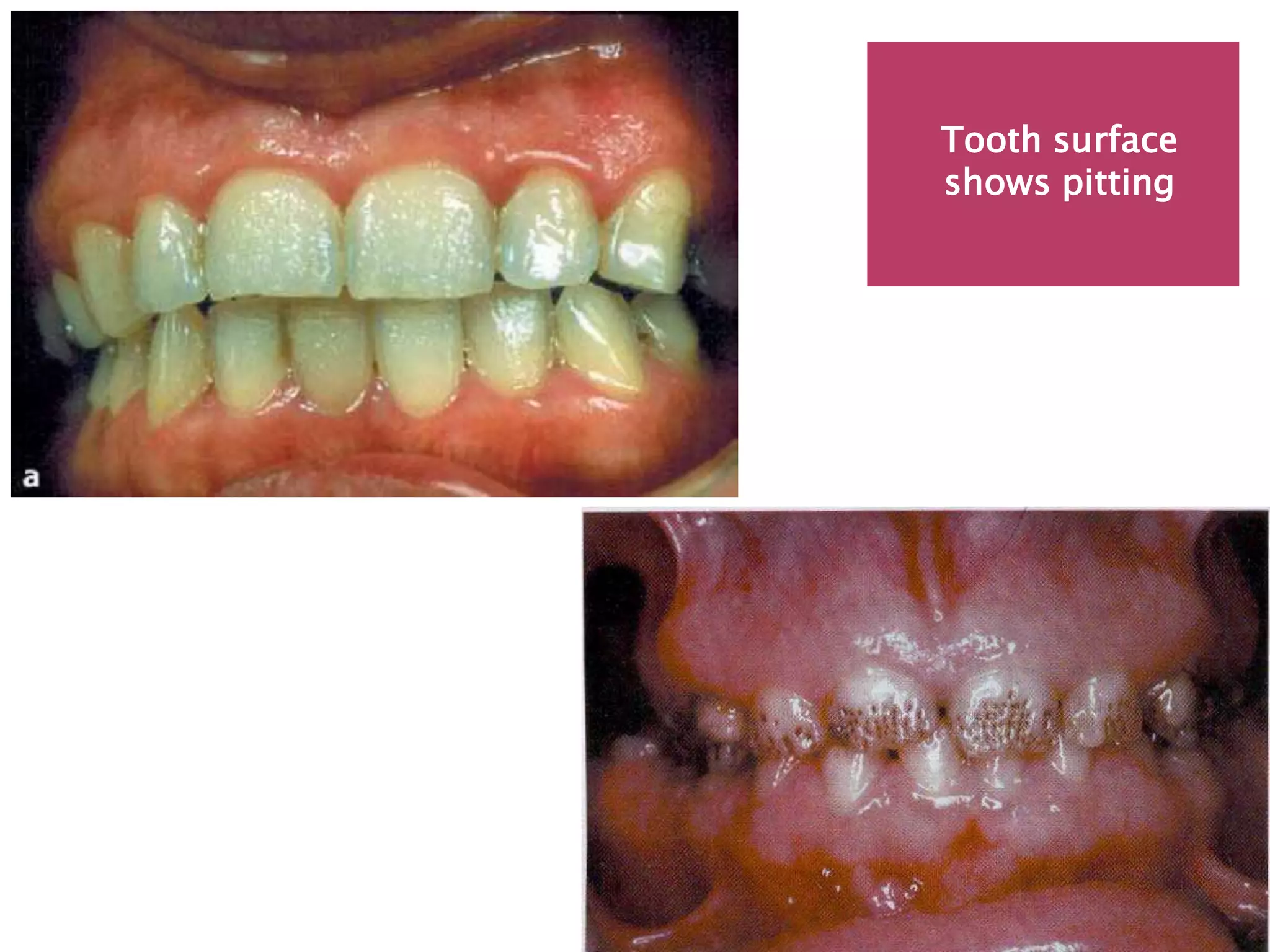 Developmental disturbances of tooth structure | PDF