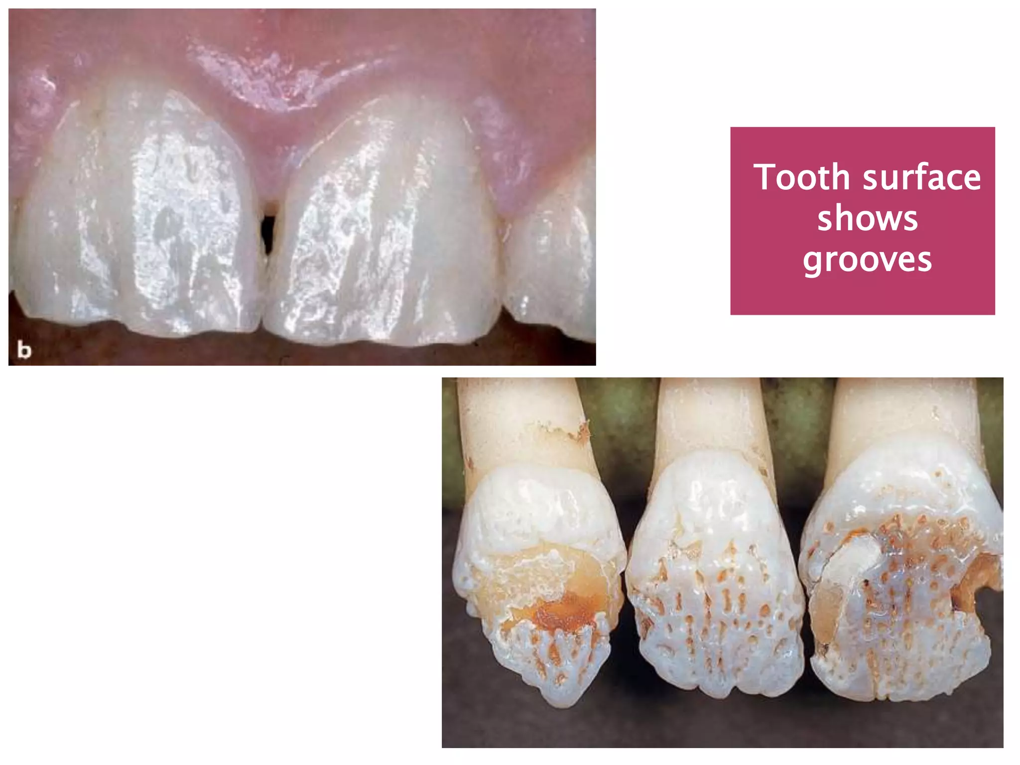 Developmental disturbances of tooth structure | PDF