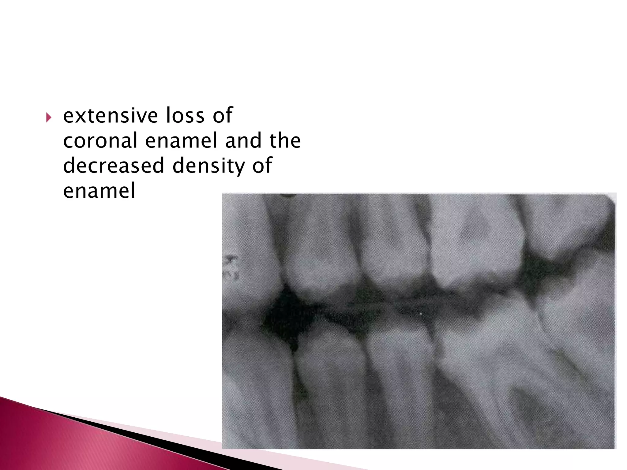 Developmental disturbances of tooth structure | PDF