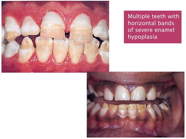 Developmental disturbances of tooth structure | PDF