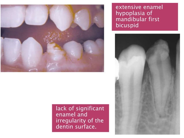 Developmental disturbances of tooth structure | PDF