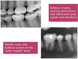 Developmental disturbances of tooth structure | PDF