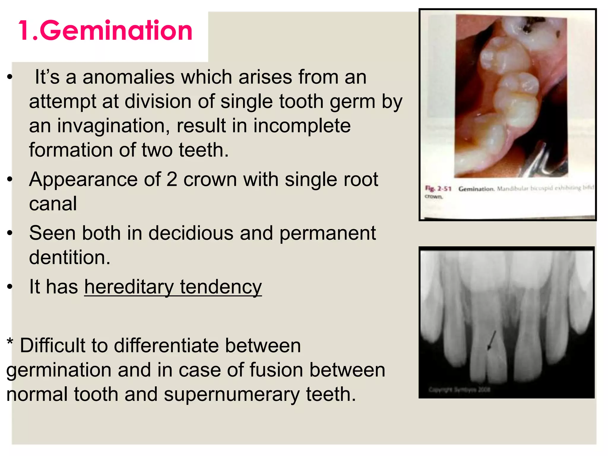 Developmental disturbances shape, size and number of the teeth | PPTX