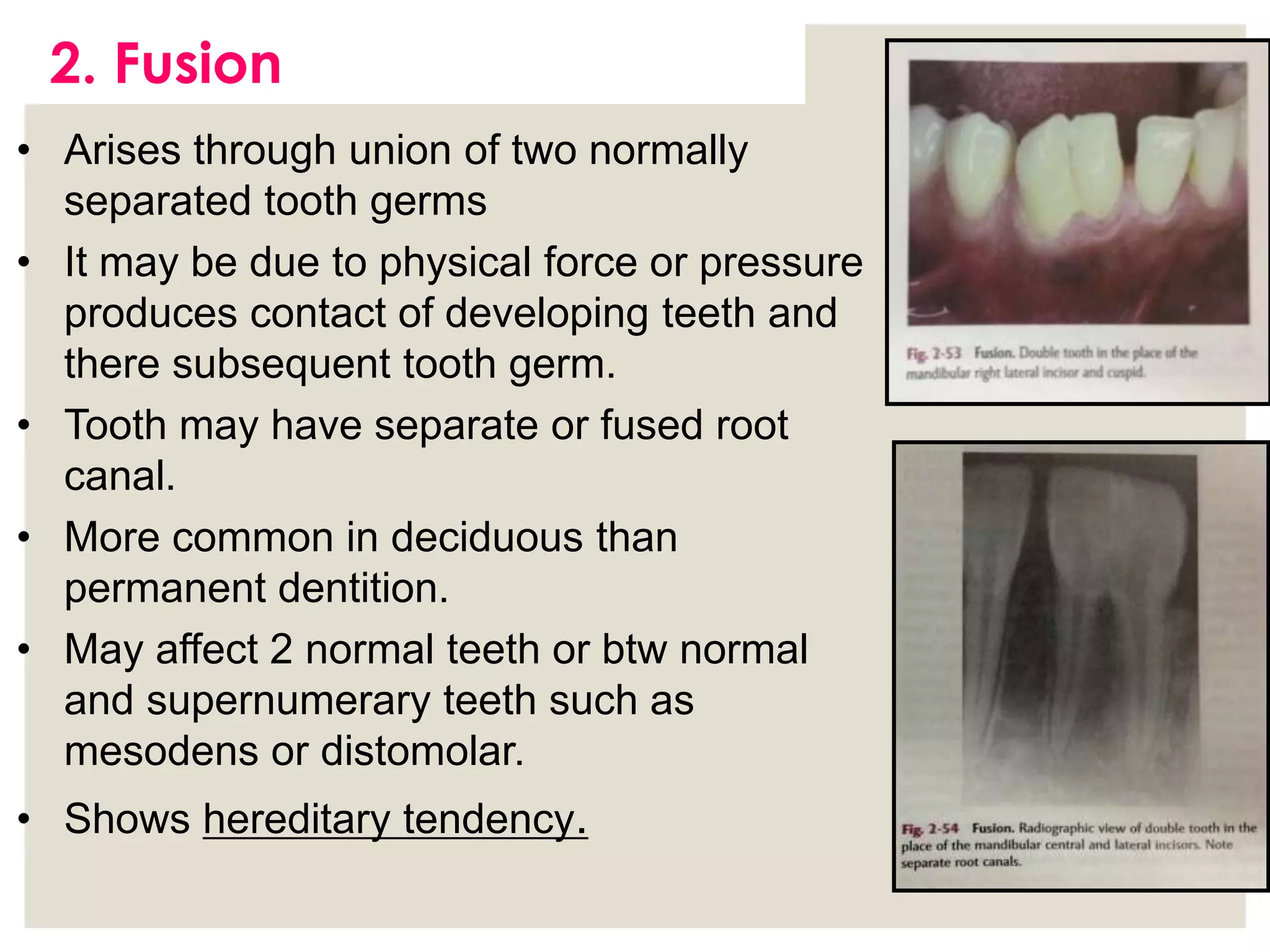 Developmental disturbances shape, size and number of the teeth | PPTX