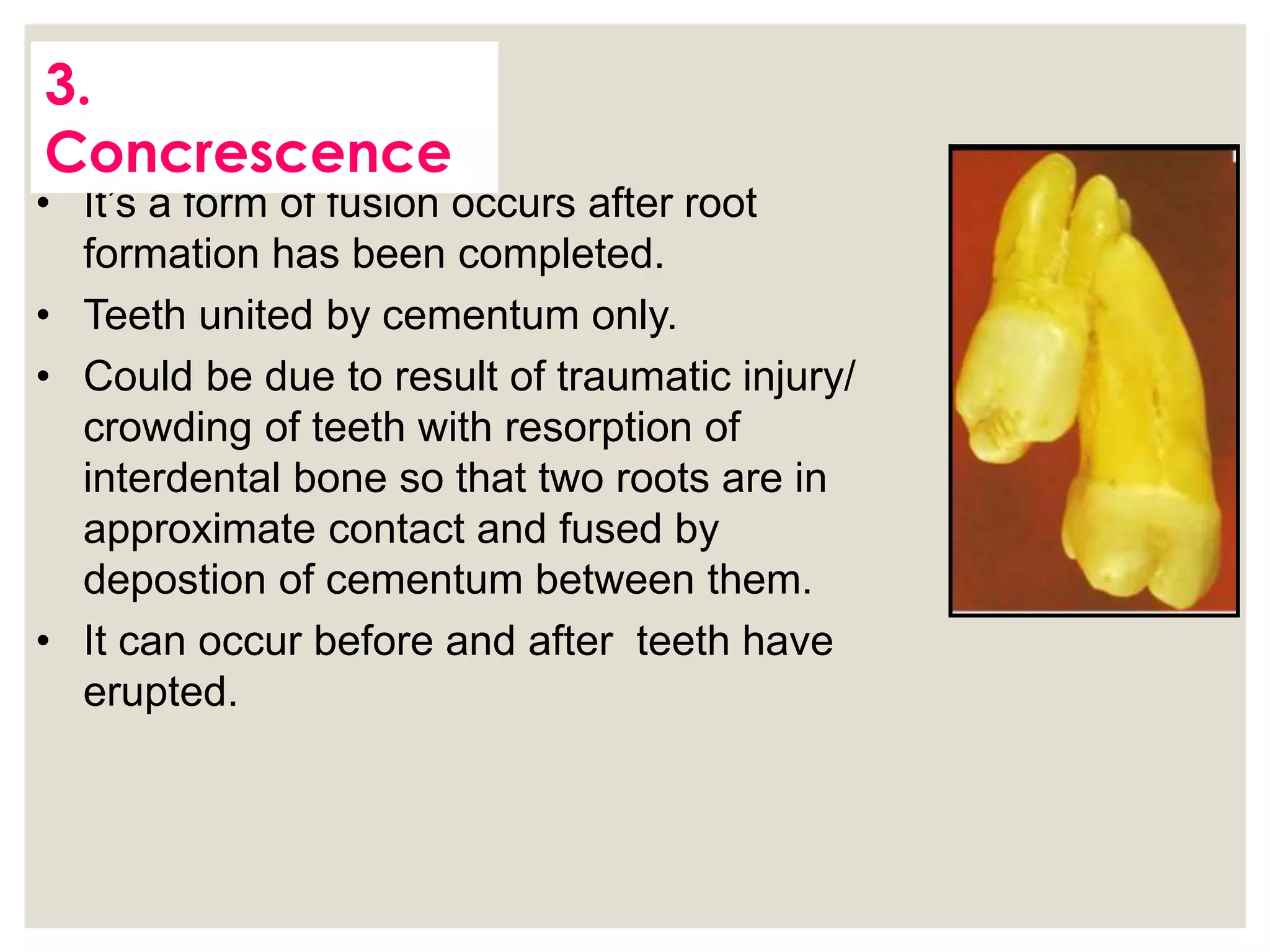 Developmental disturbances shape, size and number of the teeth | PPTX