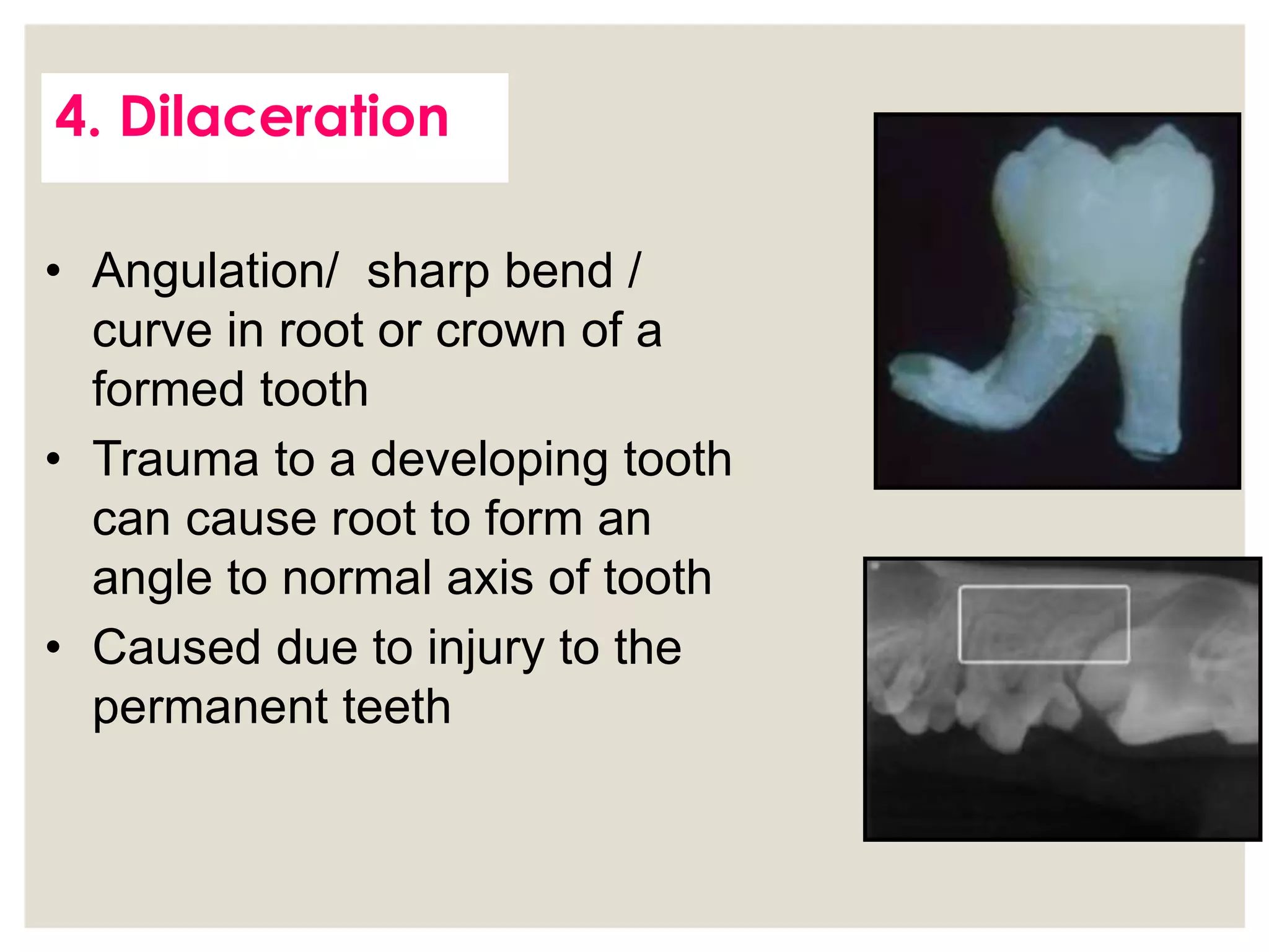 Developmental disturbances shape, size and number of the teeth | PPTX