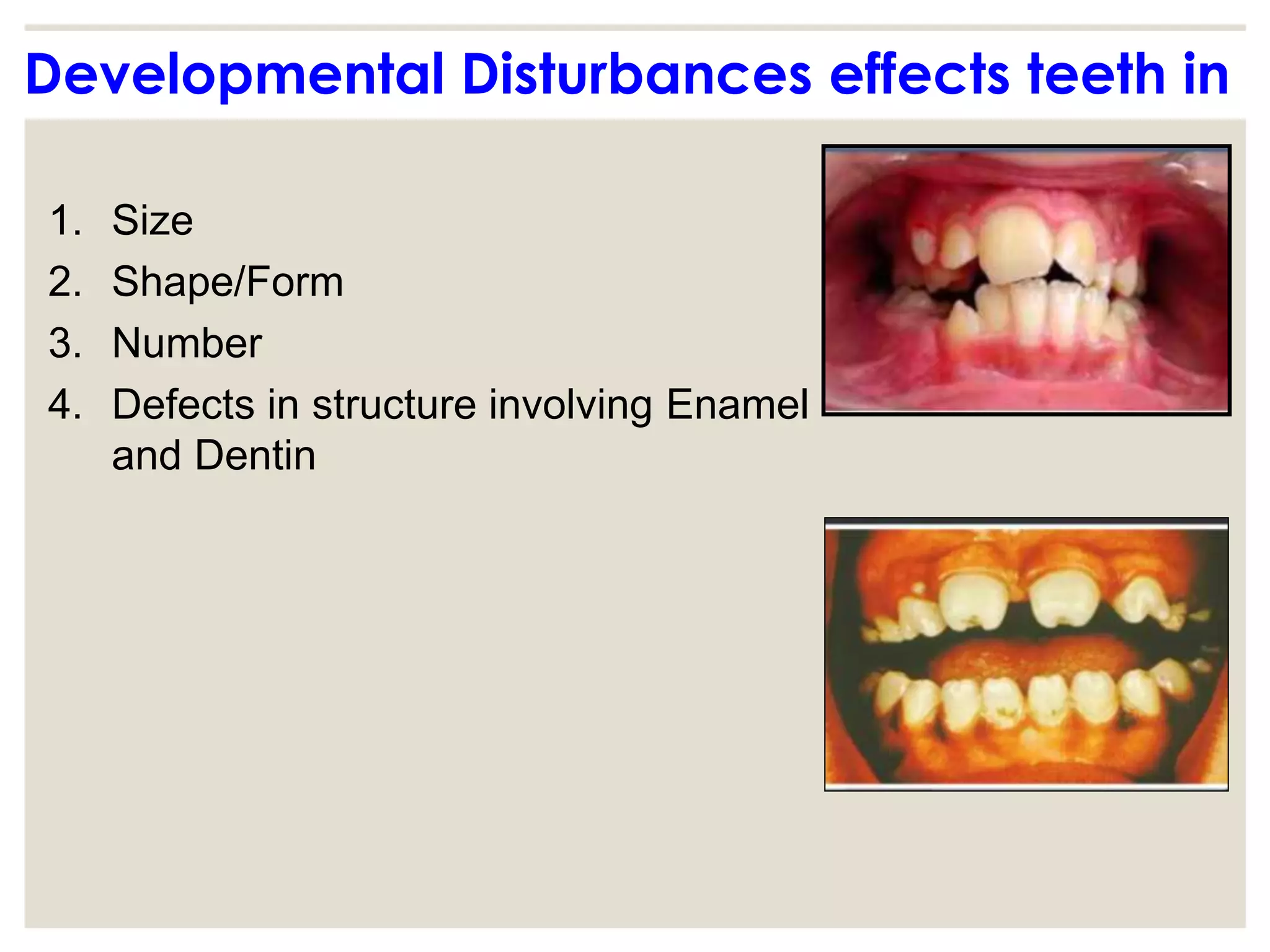Developmental disturbances shape, size and number of the teeth | PPTX