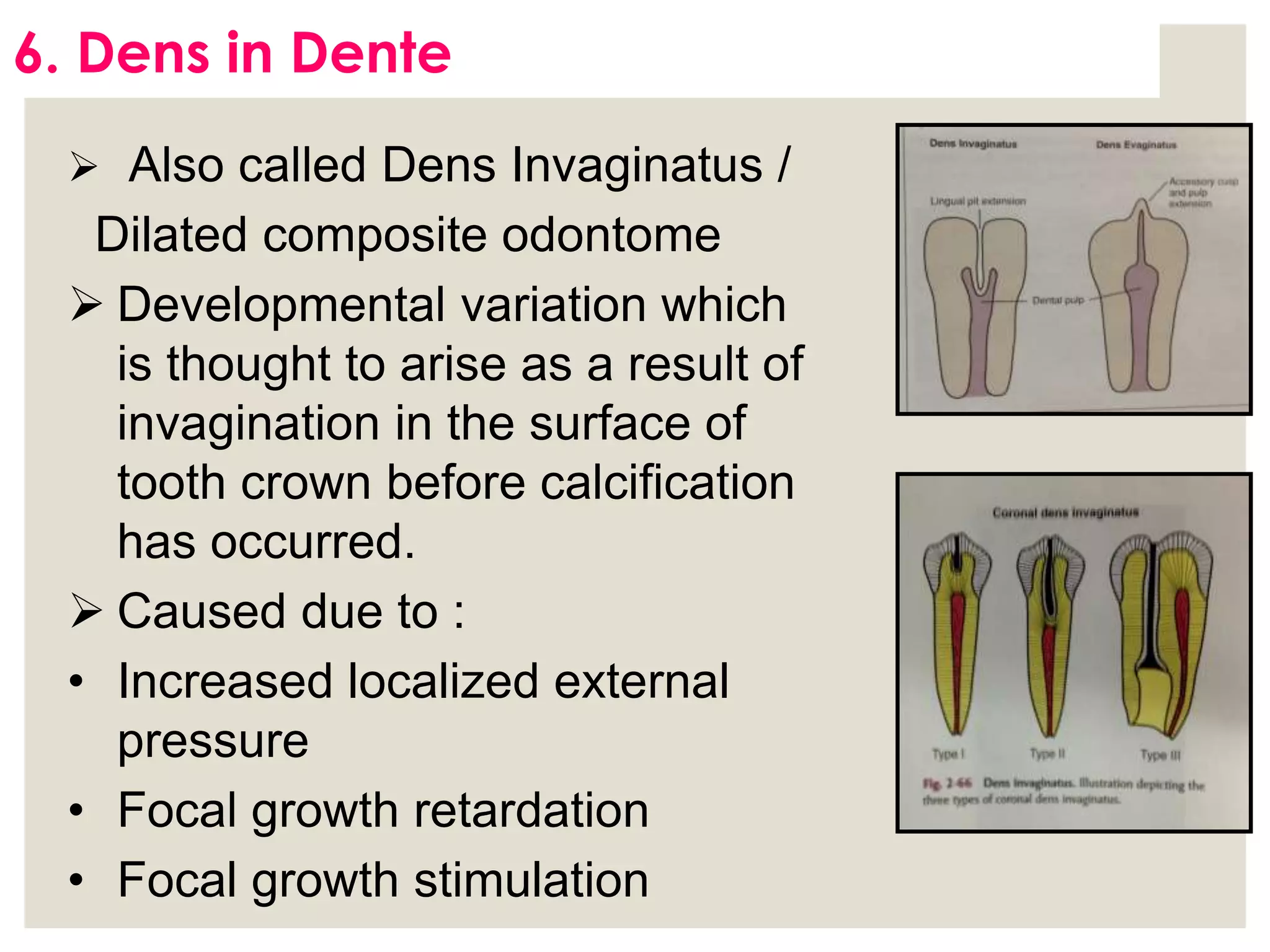 Developmental disturbances shape, size and number of the teeth | PPTX