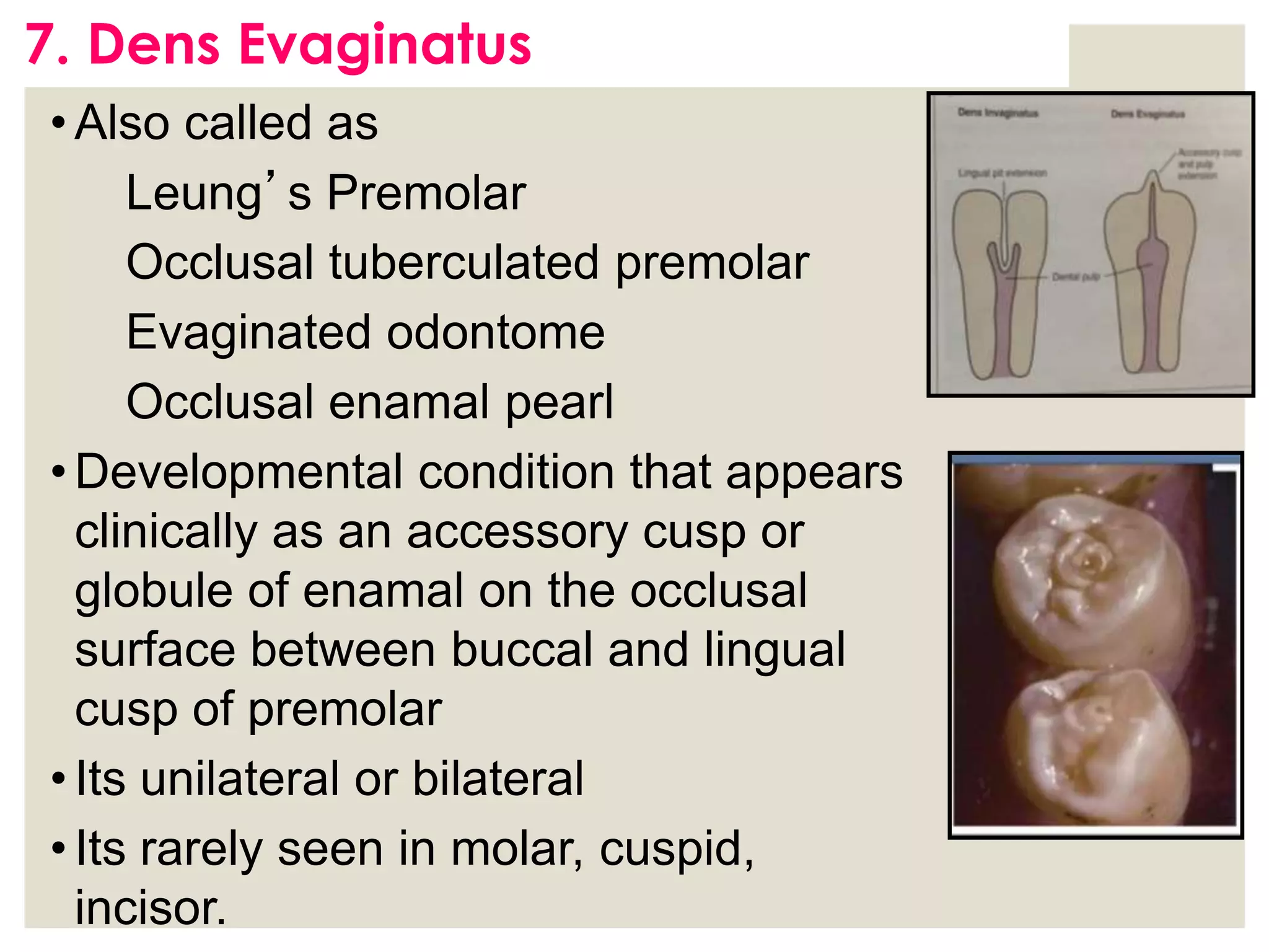 Developmental disturbances shape, size and number of the teeth | PPTX